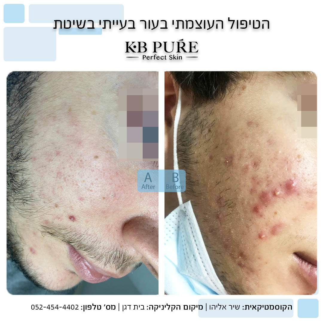 היתרונות של תכשירים קוסמטיים על רואקוטן - KB-Pure